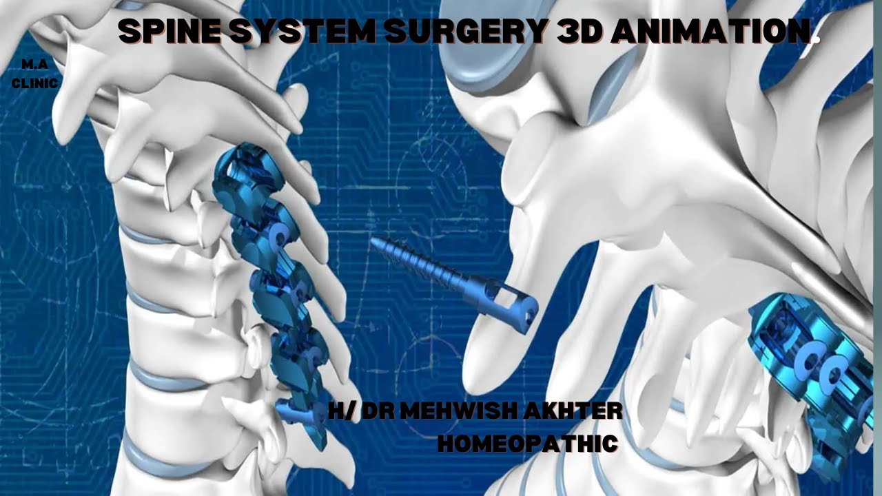 Spine System surgery 3d animation Dr. Mehwish Akhter Homeopathic! # ...