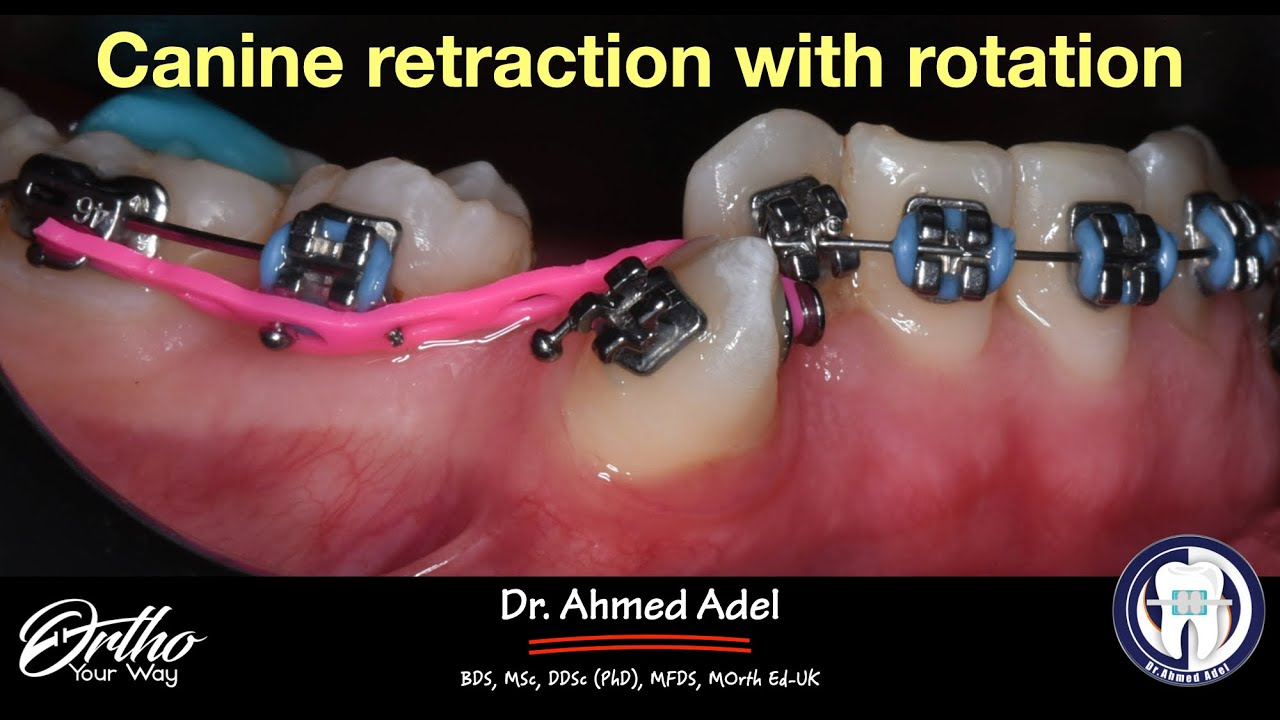 Canine retraction with rotation step by step- ahmed adel orthodontics ...