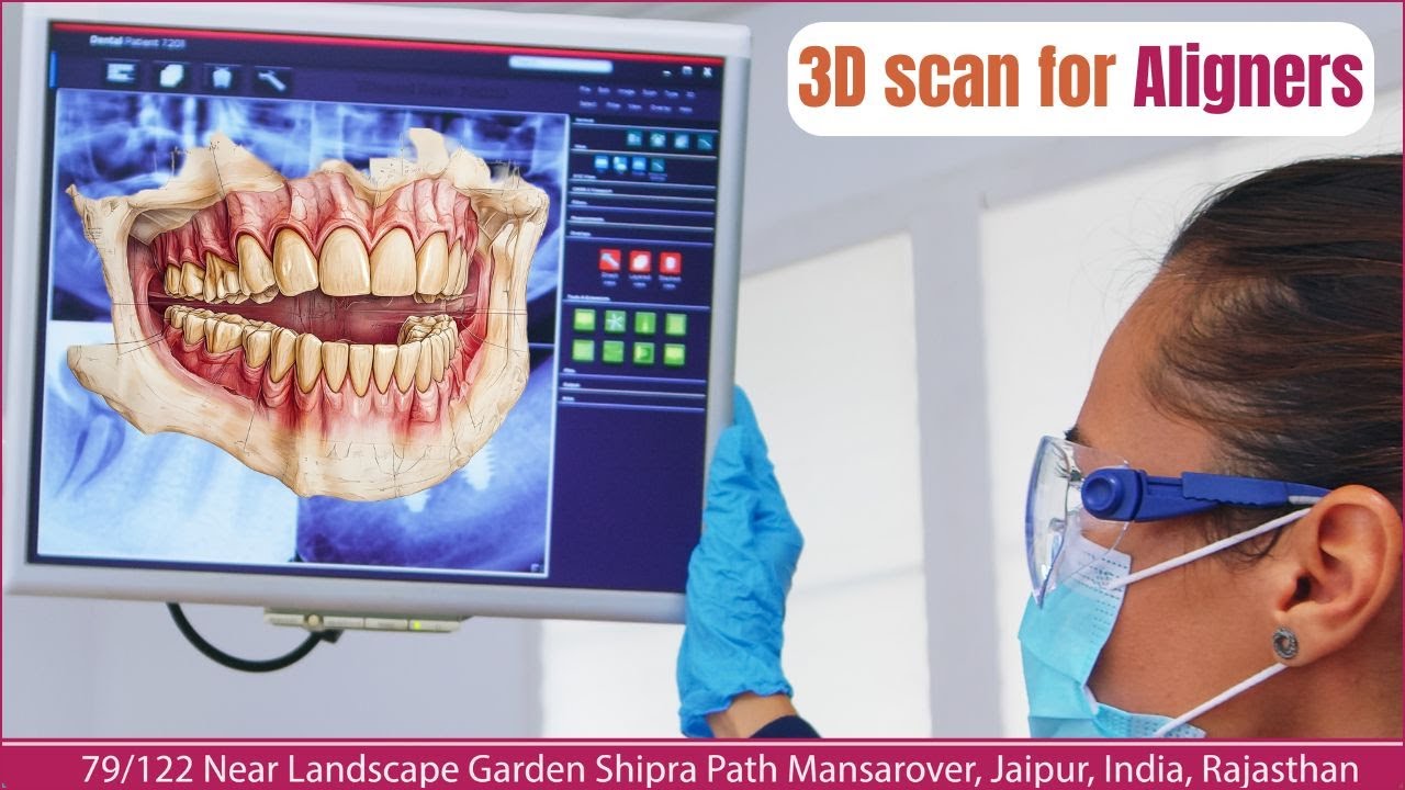 3D Scan for Clear Aligners | Advanced Dental Care by Dr. Neha Gupta ...