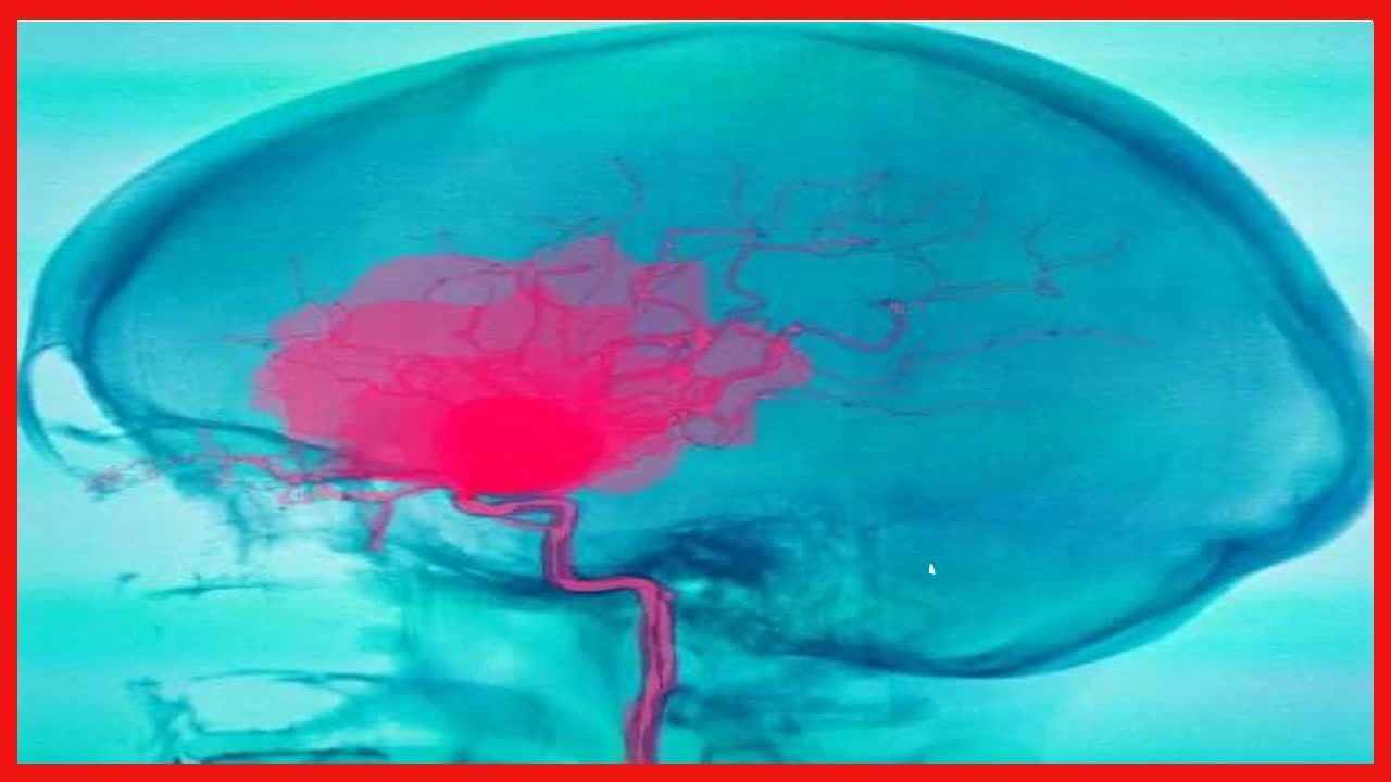 Subduralblutung und Subarachnoidalblutung: Was ist das? - YouTube