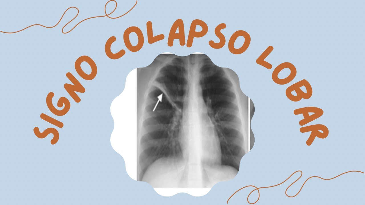 ATELECTASIA PULMONAR SIGNOS RADIOLOGICOS TELE DE TÓRAX - YouTube