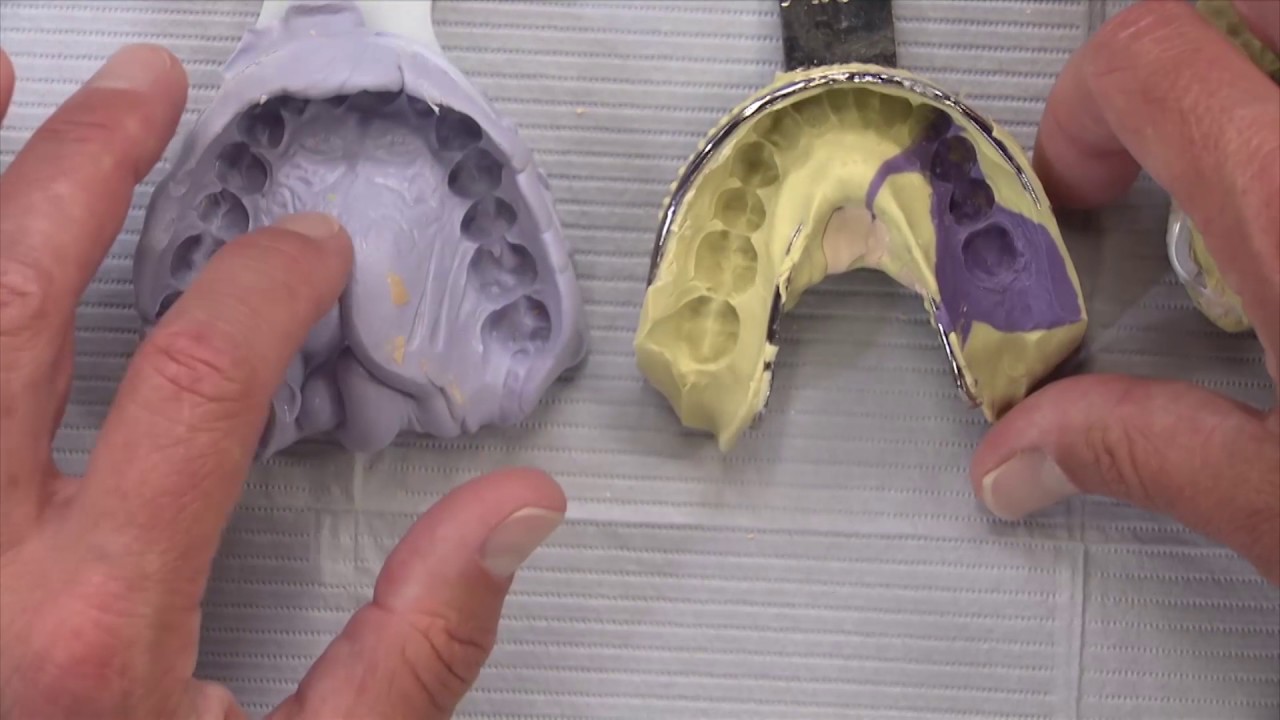 Case of the Week: Double-Arch Impression Trays - YouTube