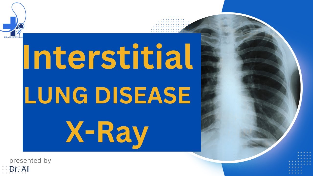 Interstitial Lung Disease Radiology: Interstitial Lung Disease Chest X ...