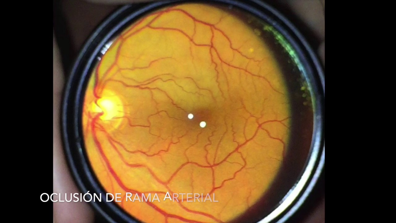 Cómo tomar fotos del fondo de ojo con tu celular - YouTube