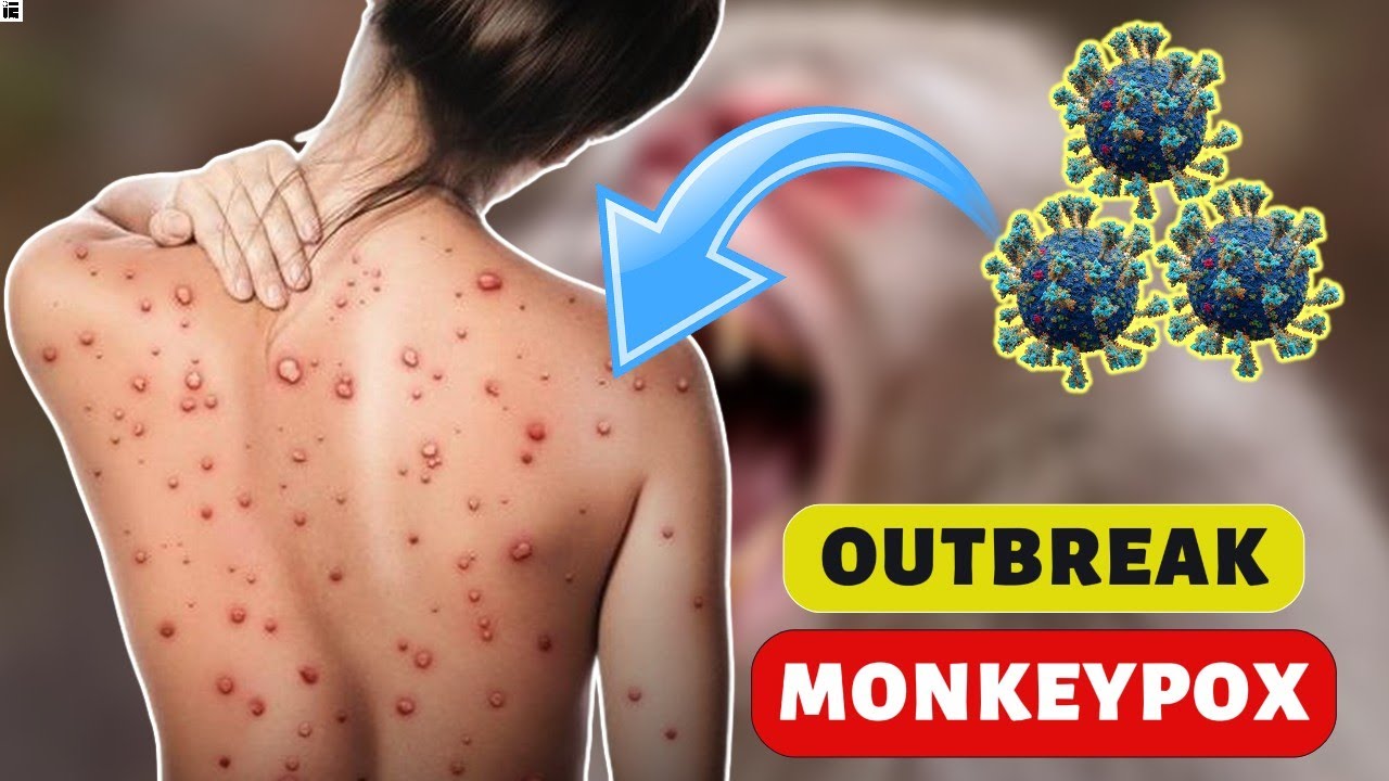 Everything you need to know about monkeypox - YouTube