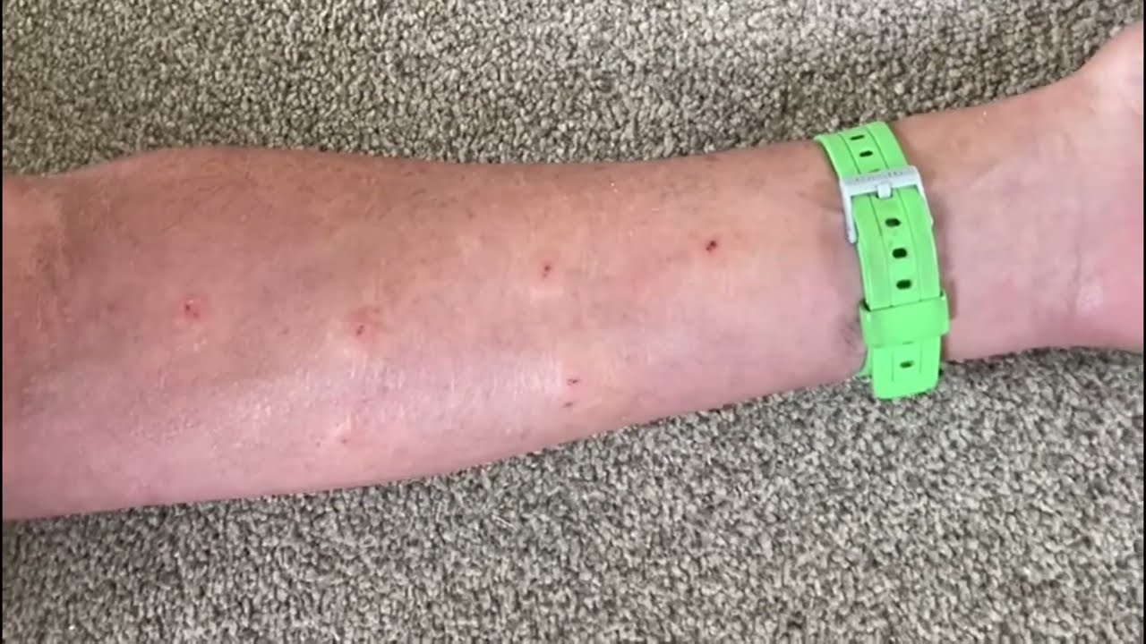 How to cure Monkeypox! - YouTube