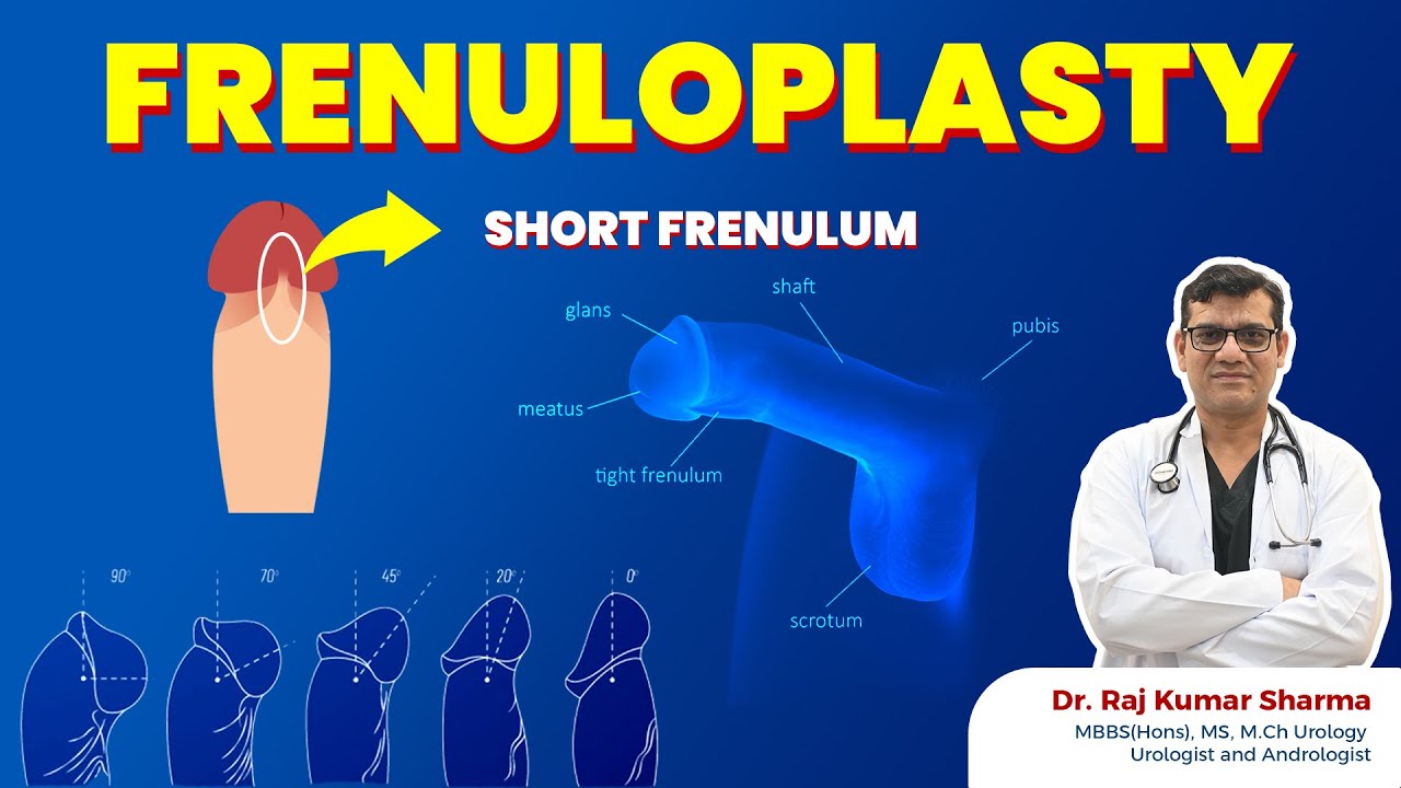 Tight Frenulum and Frenuloplasty by Dr Raj Kumar Sharma - YouTube