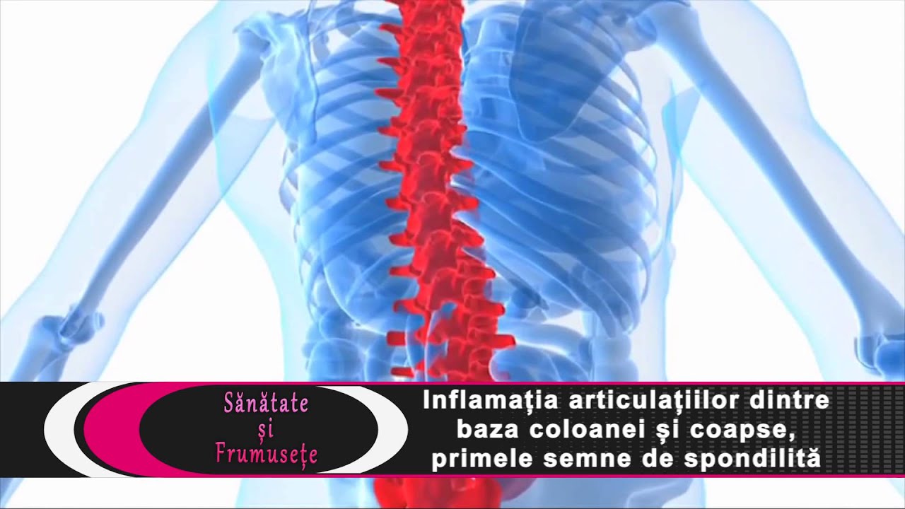 69 Sanatate si frumusete - Spondilita 21 martie 2014 - YouTube