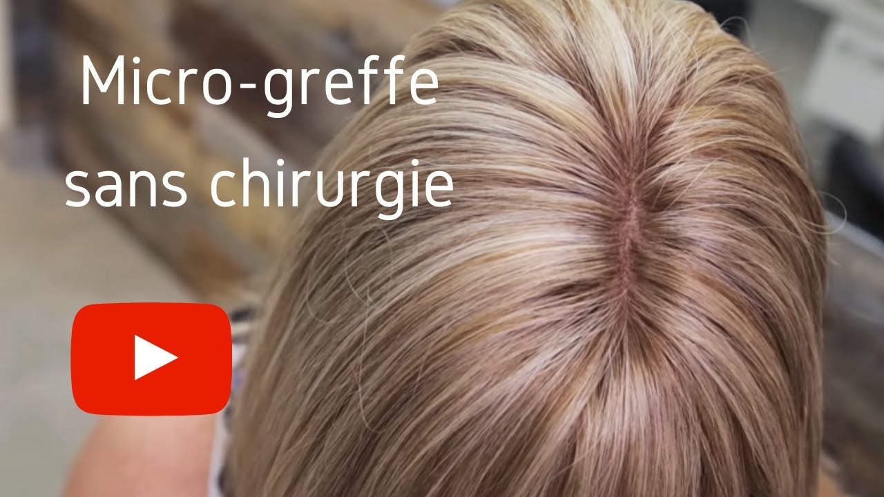 Cheveux fins : Solution indécelable / Micro-greffe sans chirurgie - YouTube