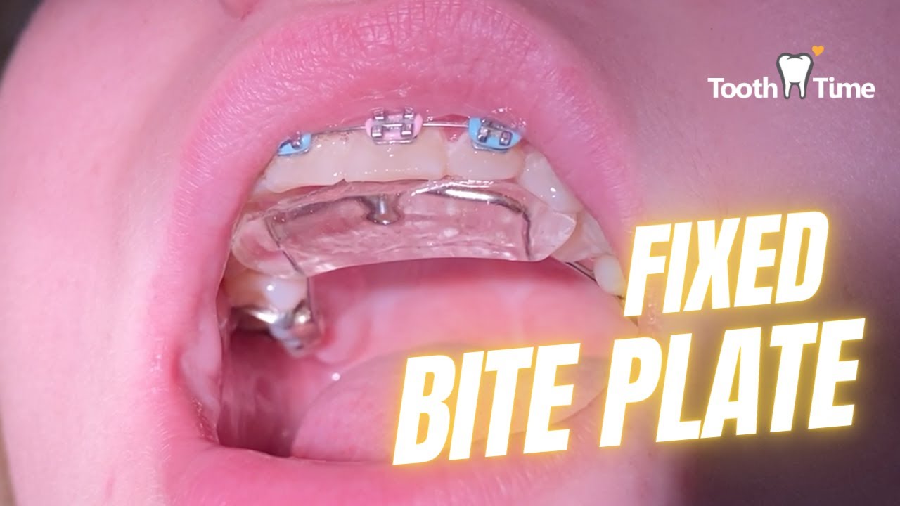 Deep Bite Braces - Fixed Bite Plate - ToothTime Family Dentistry - YouTube