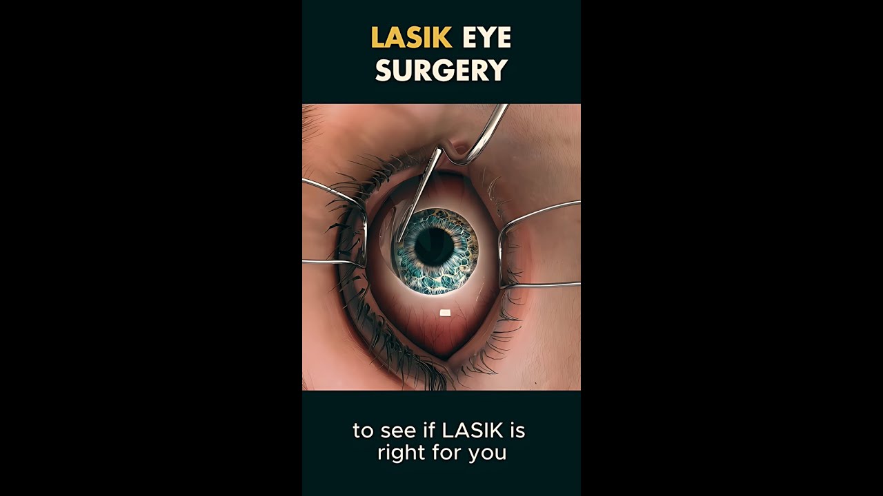 LASIK Eye Surgery Procedure | 3D Medical Animation Explanation Video ...