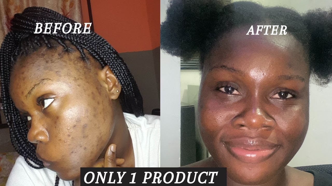 How I Finally Got Rid of My Extremely Stubborn Acne and Dark Spots ...