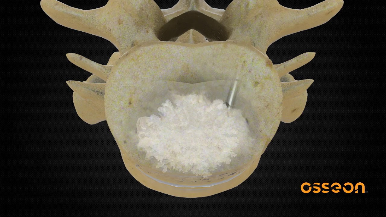 Osseon Vertebral Augmentation - YouTube