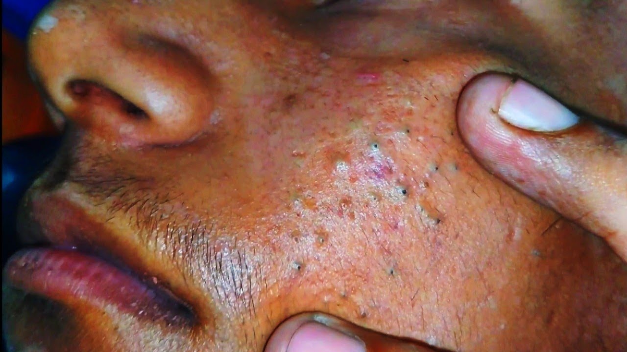 sac be spa blackheads elderly 2024 | sac be spa boy age blackheads 2024 ...