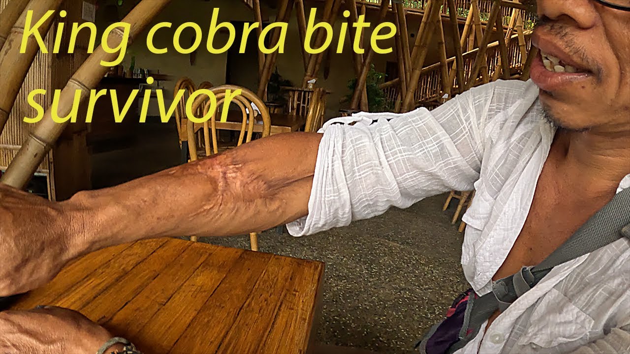King cobra bite survivor Indonesia.🇮🇩 - YouTube