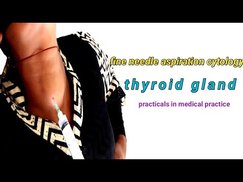 FNAC in the Diagnosis of Thyroid Gland - YouTube