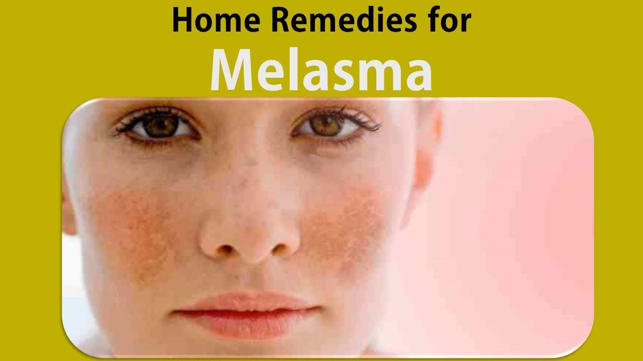 Home Remedies for Melasma - Sandalwood & Fresh Lemon Juice - YouTube