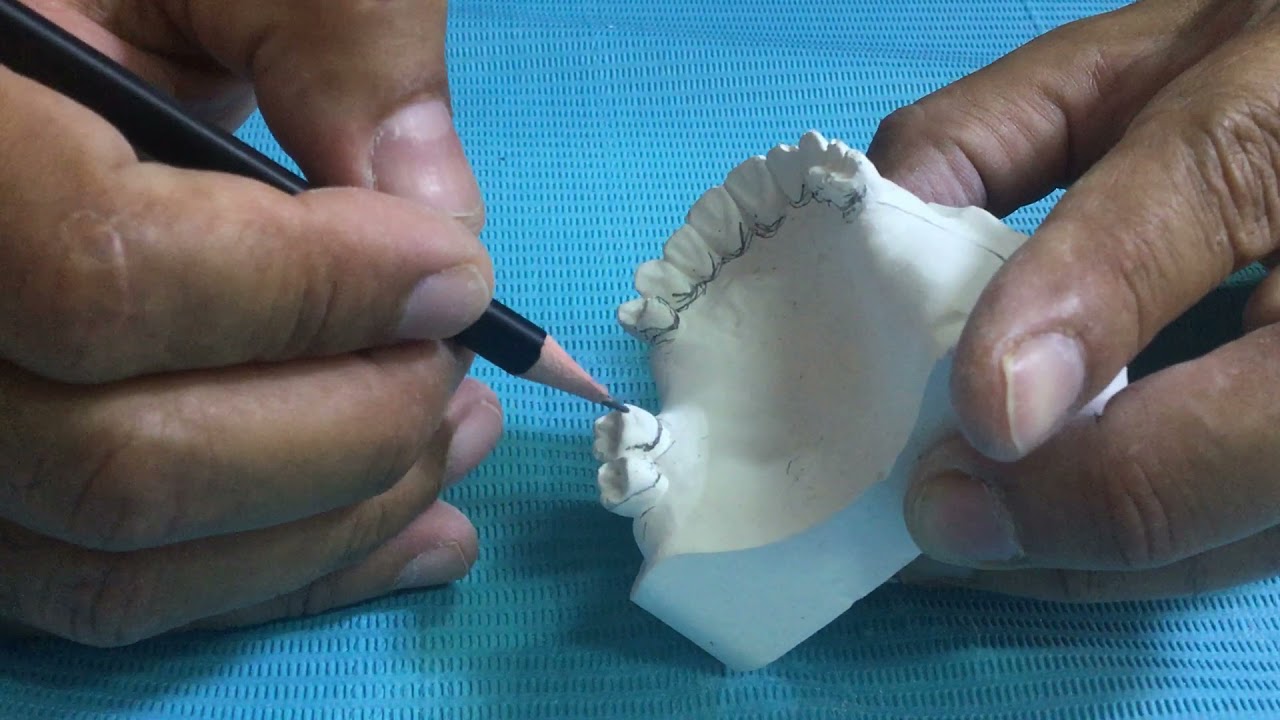 Max class II mod 1 acrylic RPD designing on cast - YouTube