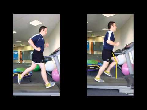 inFORM Running technique for anterior compartment syndrome. www ...