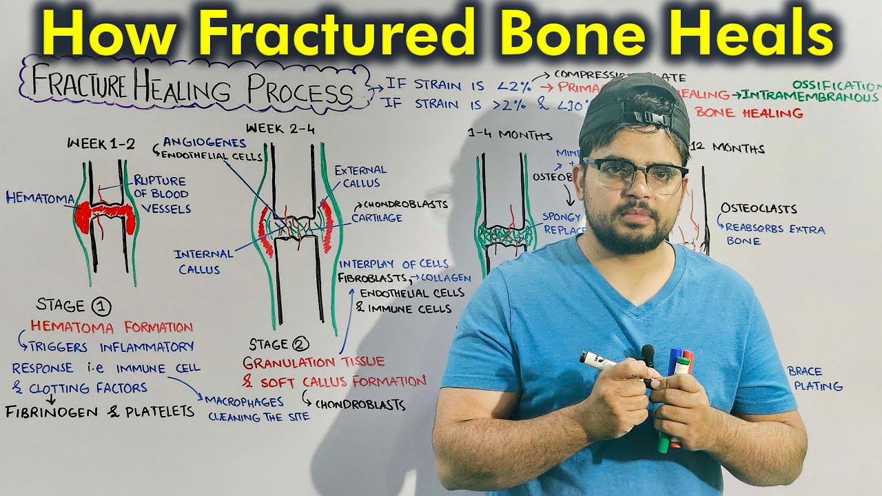 Fracture Healing Process: Repair of Fractured Bone - YouTube