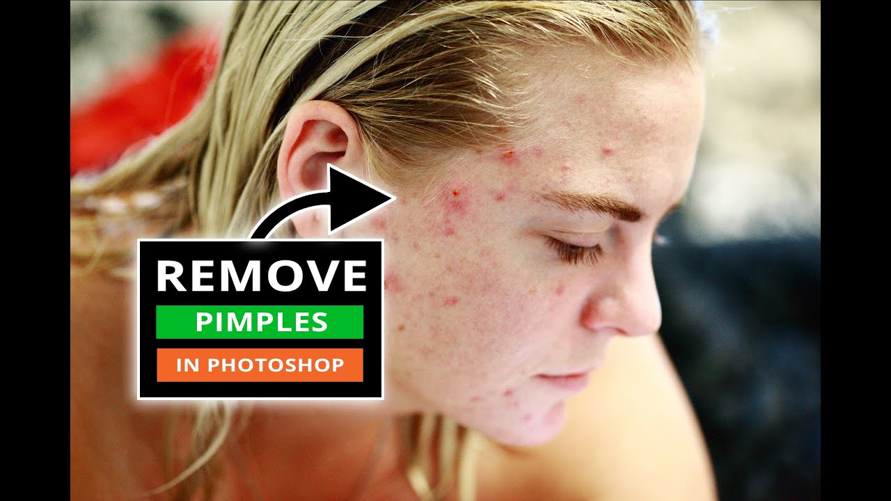 How To Remove Pimples In Adobe Photoshop YouTube how-to-remove-pimples-in-adobe-photoshop-youtube
