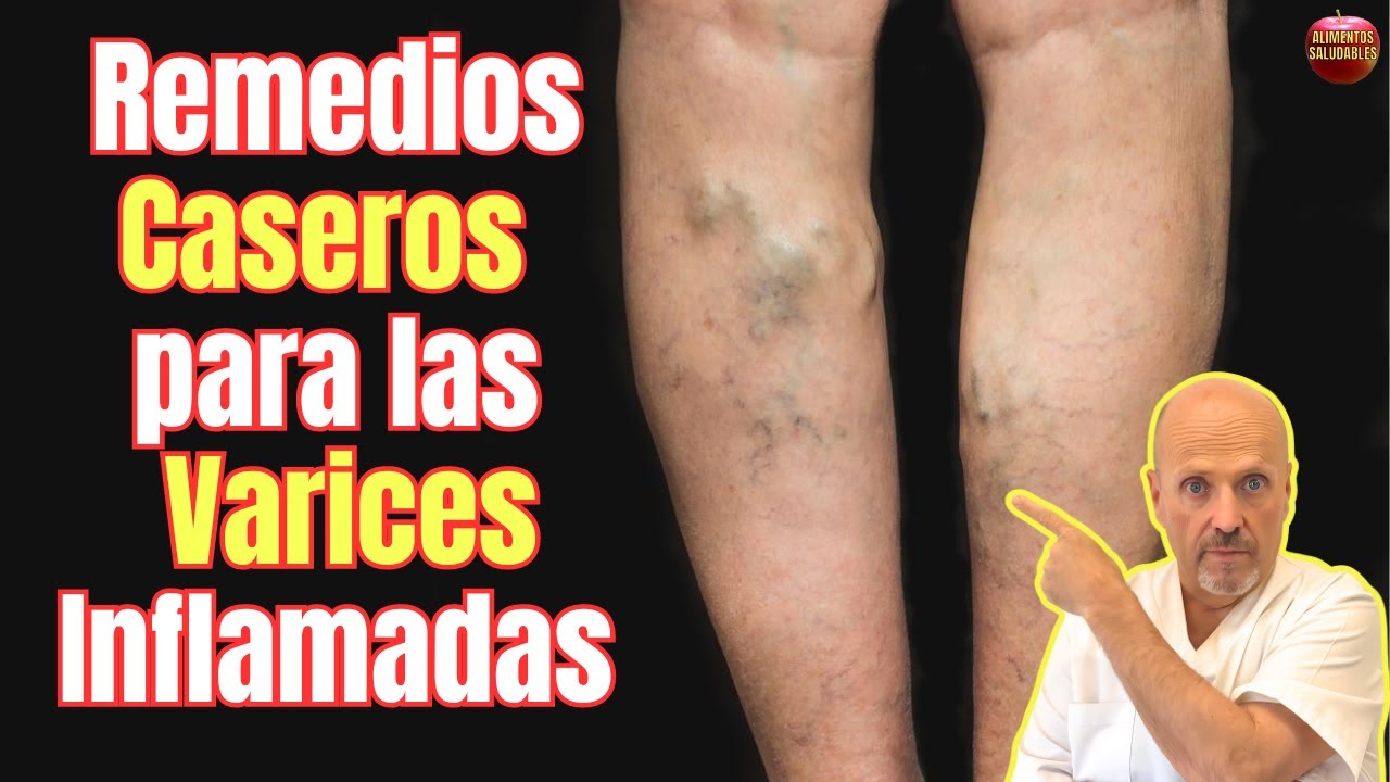 REMEDIOS CASEROS PARA LAS VARICES GRUESAS o INFLAMADAS » SHIVAWATER