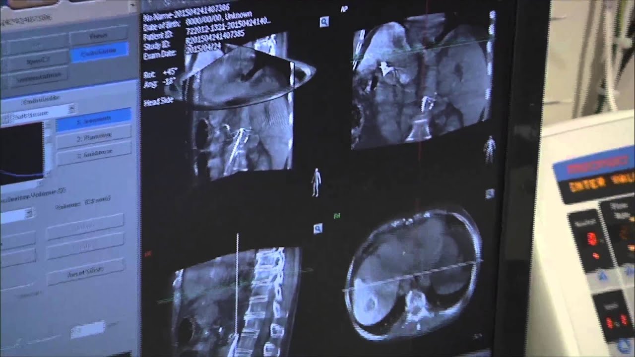 Drug-Eluting Bead Chemoembolization (DEB-TACE) for Liver Cancer - YouTube