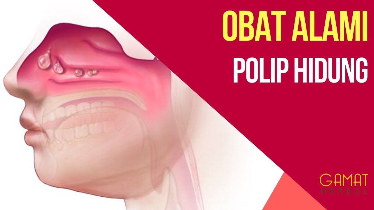 Polip Adalah Penyakit - Homecare24
