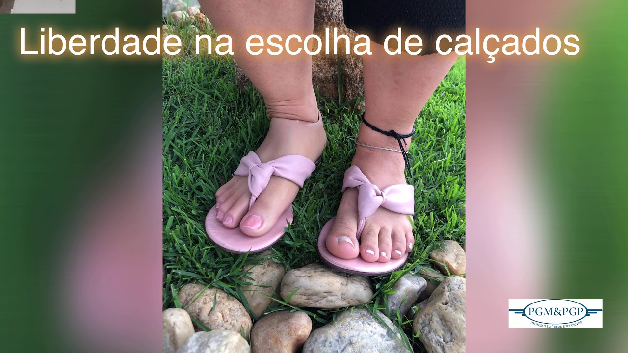 Prótese para amputação parcial de pé - YouTube