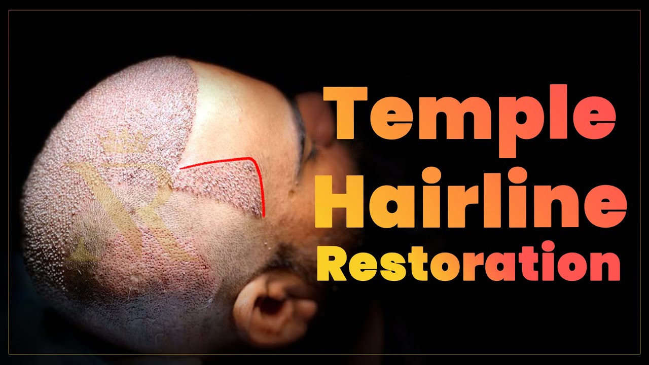 Temple Hair Restoration Explained: Enhancing Your Hairline 🧐 | New ...