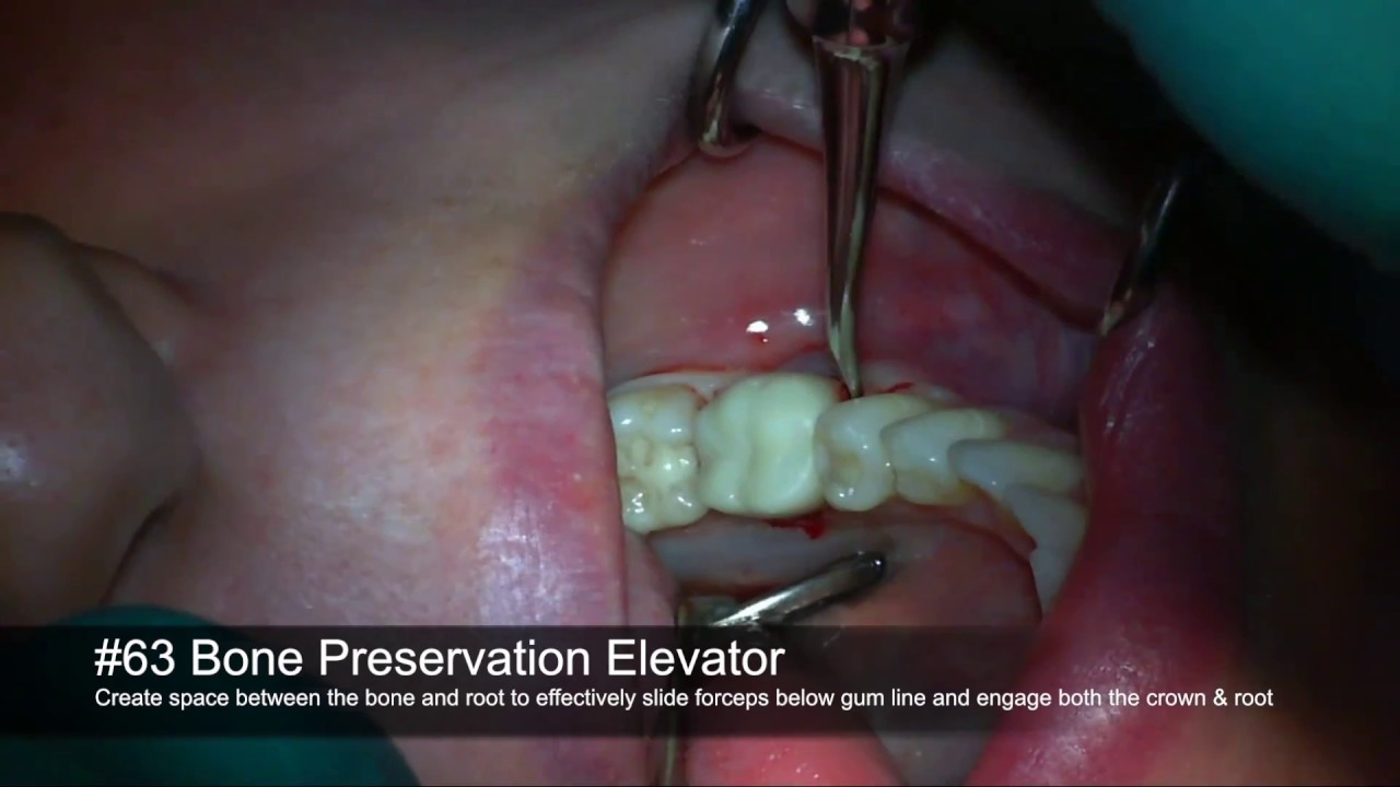 Use of X-Otomes & Bone Preservation Elevators to perform an atraumatic extraction - YouTube