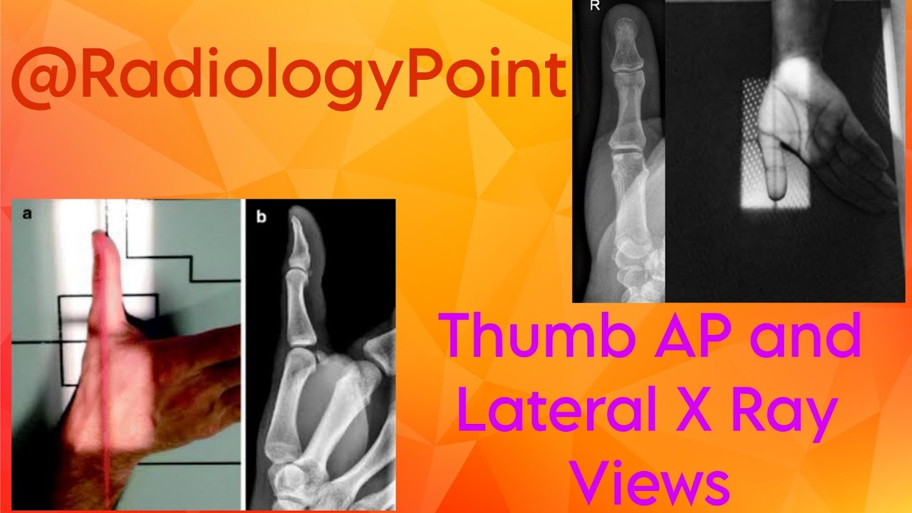 Thumb - AP and Lateral view of X Ray | Digit Radiography | at ...