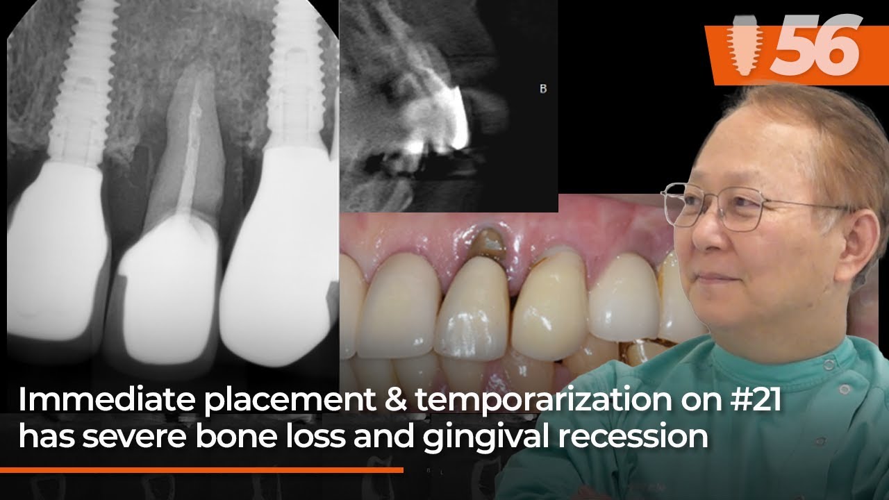 [Preview] Immediate placement and temporization on #22 with severe bone ...