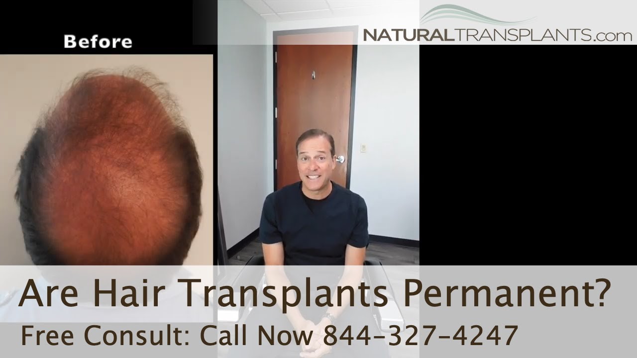 Are Hair Transplants Permanent? Yes! See Dr. Harold Siegel 7 Years ...