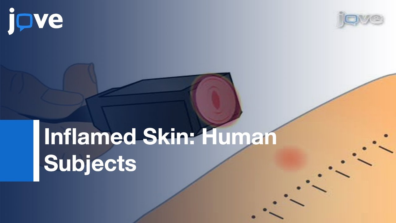 Determining Heat & Mechanical Pain Threshold Inflamed Skin: Human ...