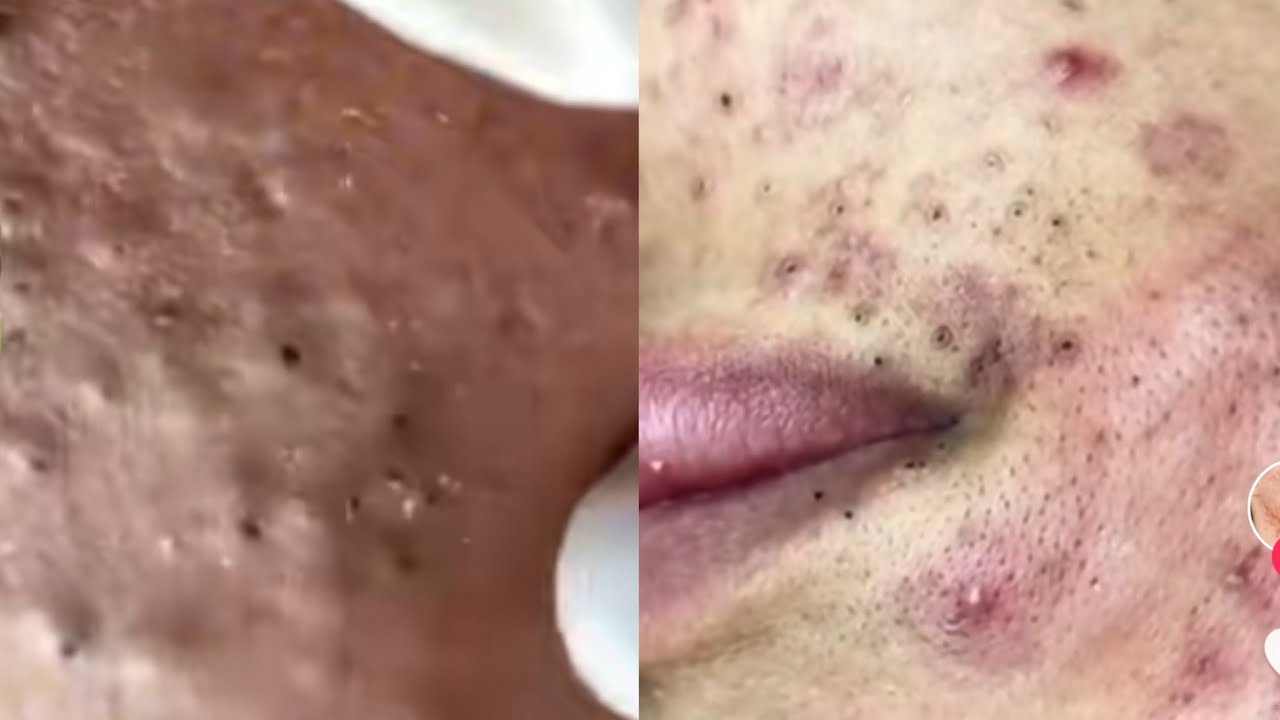 Acne treatment - satisfying blackheads and pimples compilation p.36 ...