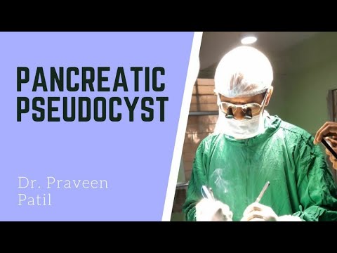 PANCREATIC PSEUDOCYST | CYSTOGASTROSTOMY - YouTube
