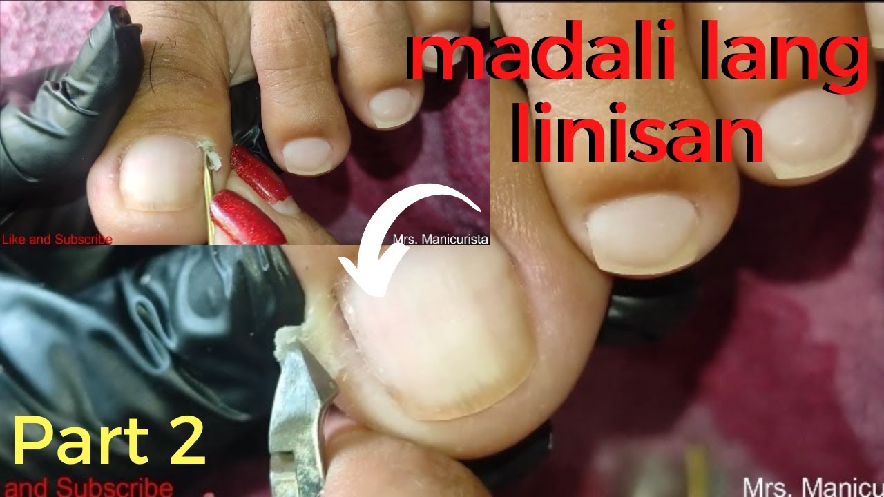 Vlog 604|Dry Skin/Ingrown Removal| PEDICURE 504 - YouTube