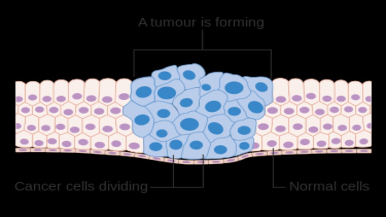neoplasm - neoplasia, what is cancer? introduction to neoplasm - YouTube