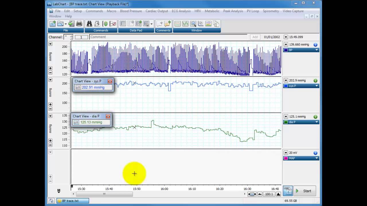 Calculating Systolic Diastolic And MAP From Blood Pressure Traces calculating-systolic-diastolic-and-map-from-blood-pressure-traces