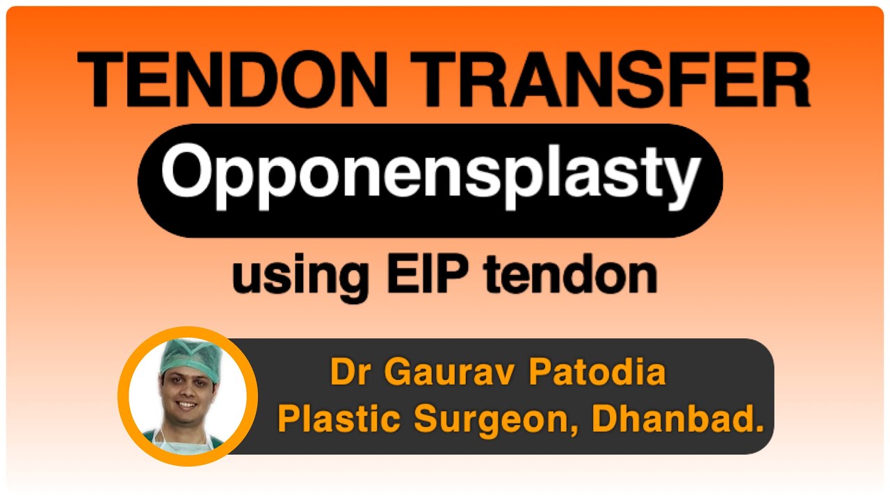 Opponensplasty using EIP tendon for median nerve palsy - Dr Gaurav ...