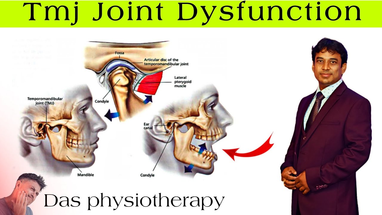 TMJ Joint Dysfunction !! Patient is recovery from Das Physiotherapy ...