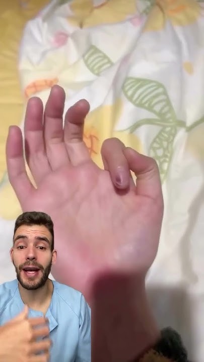 Mano de 6 dedos #curiosidades #sabiasque - YouTube