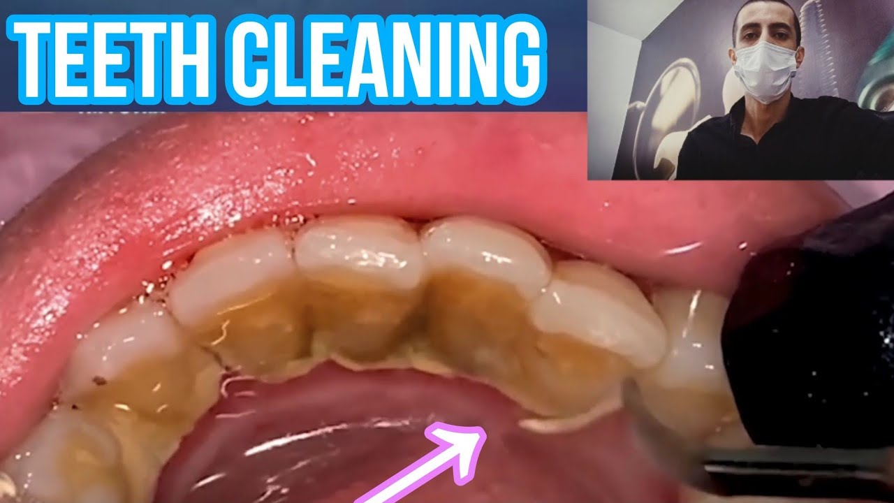 tartar removal front teeth - YouTube
