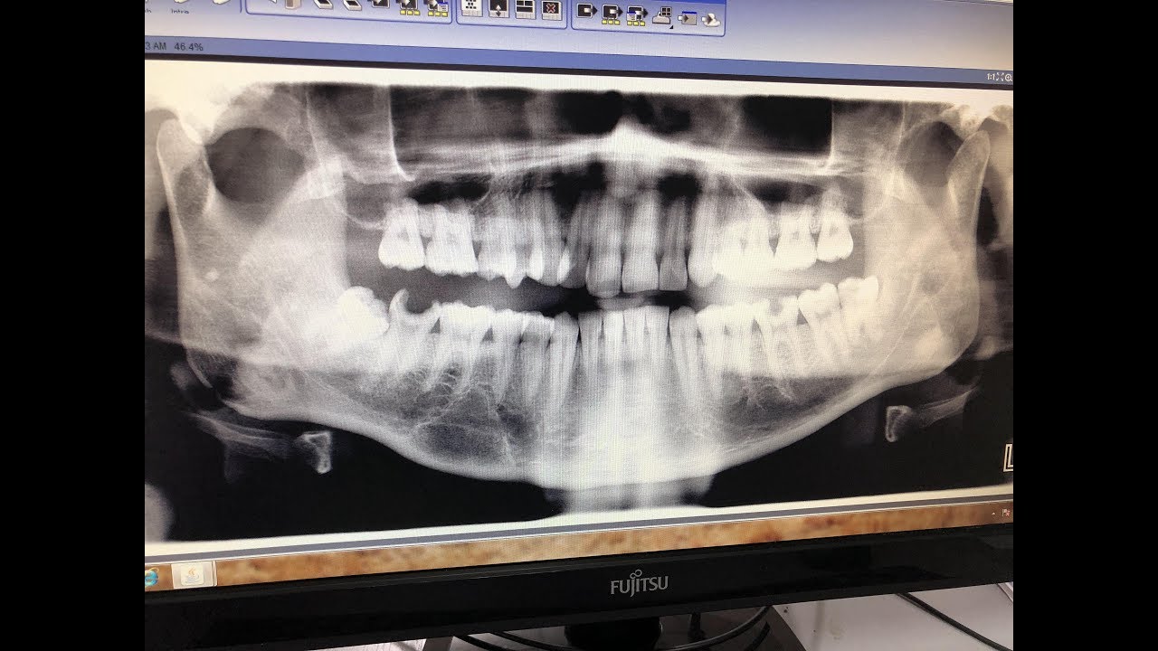 Surgical Extraction of Impacted lower 8 - Dr. Mohamed Al-Jubori - YouTube