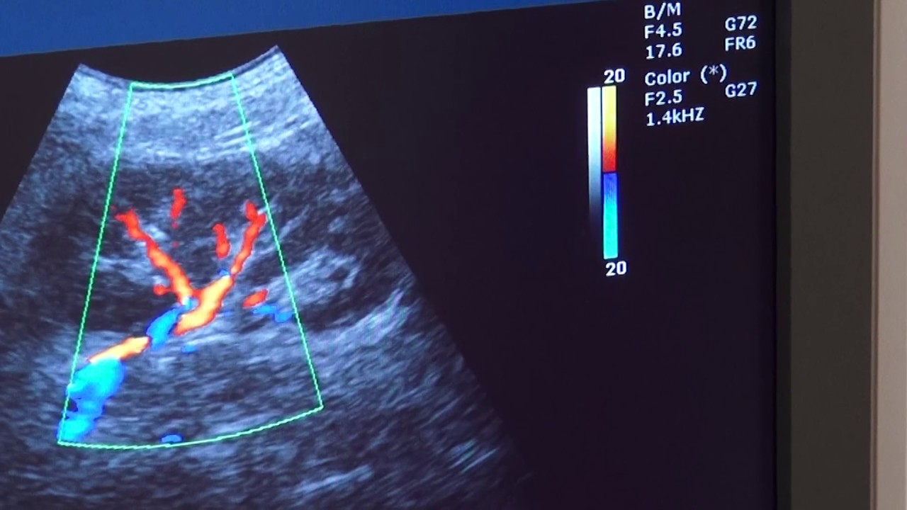 УЗИ сканер Edan U2 - YouTube