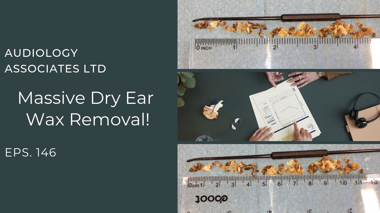MASSIVE DRY EAR WAX REMOVAL - EP 146 - YouTube