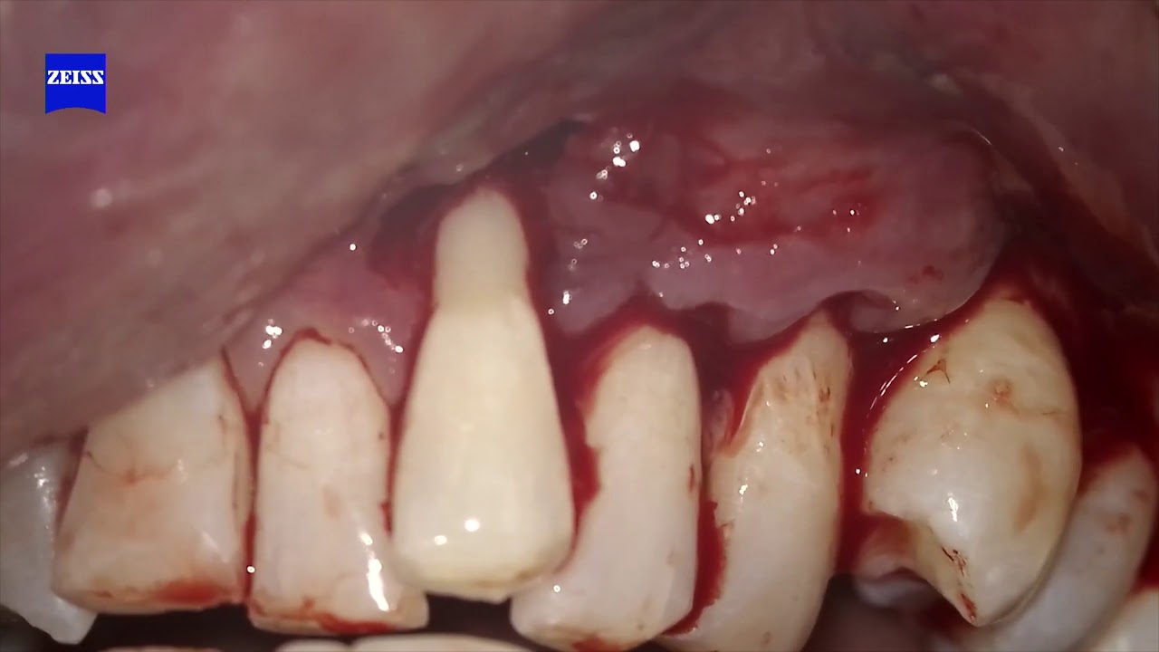 Microsurgery for lateral sliding flap with CTG on tooth #25 - YouTube