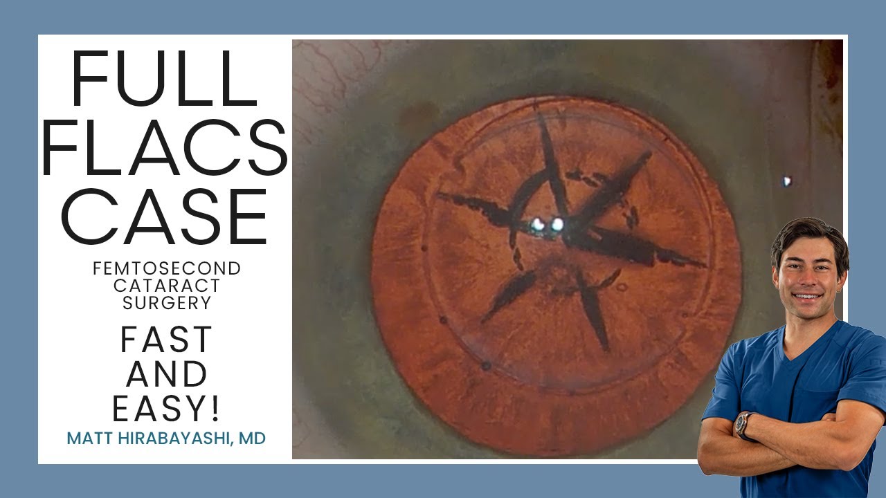 FULL Femtosecond-Assisted Laser Cataract Surgery (Fast and Easy!) - YouTube