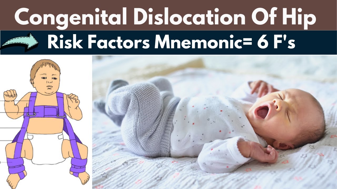 Mnemonic For Congenital Dislocation Of Hip Risk Factors | Congenital ...
